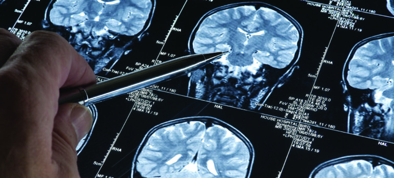 Traumatic Brain Injury – Crystal River MRI and Imaging
